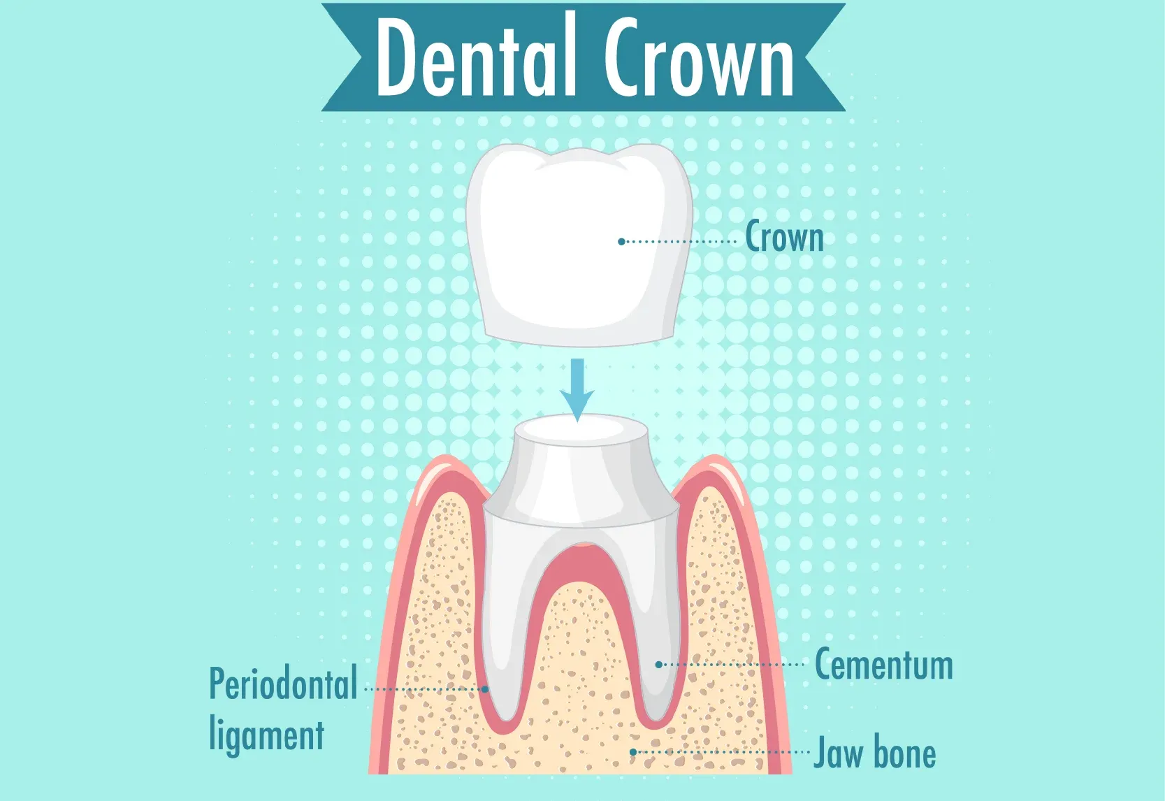 Dental Crowns vs Fillings Key Difference Explained.webp